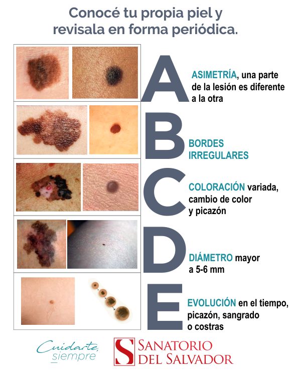 DÍA MUNDIAL CONTRA EL MELANOMA - SALUD FEMENINA